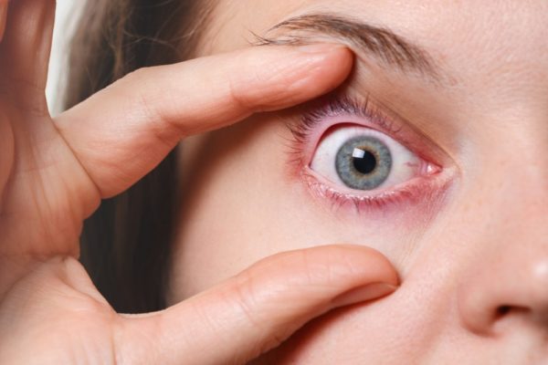 The quickest and easiest way to get rid of a chalazion! - Laura Crawley ... The quickest and easiest way to get rid of a chalazion! - Laura Crawley ...